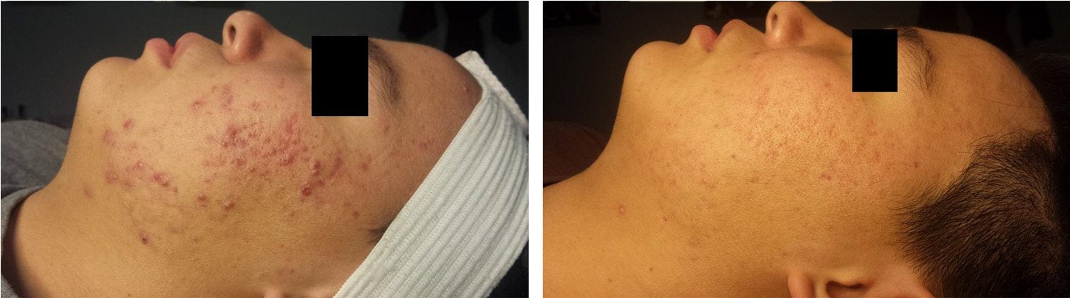 Acne Treatment Results