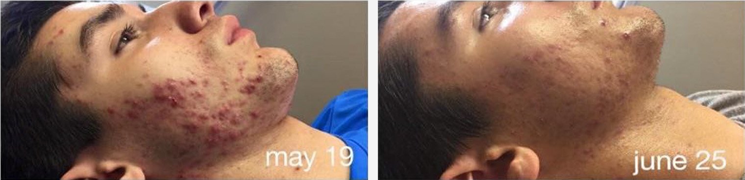 Acne Treatment Results
