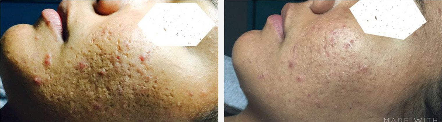 Acne Treatment Results