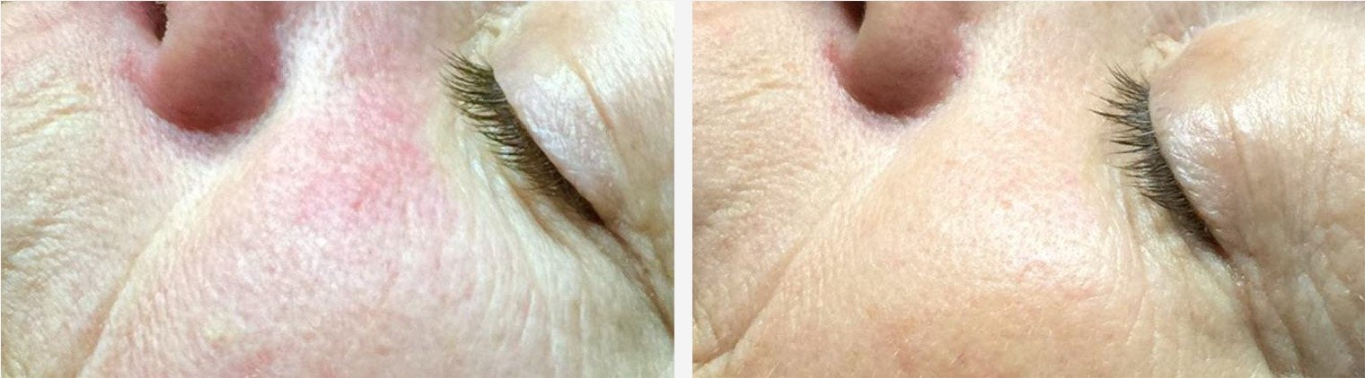 LED Light Therapy Before/After Results for Anti-Aging | Celluma